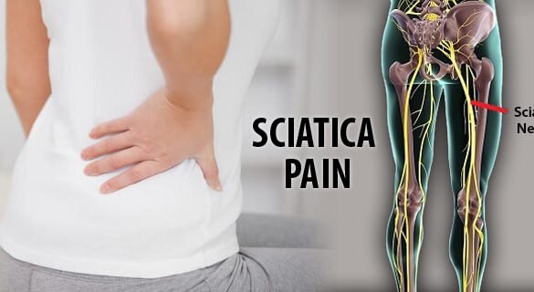 What Causes Sciatica to flare up? Quick Answers for Sciatica