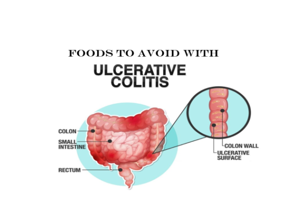 Foods to avoid with ulcerative colitis